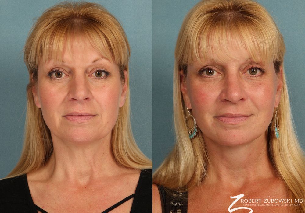 robert before and after